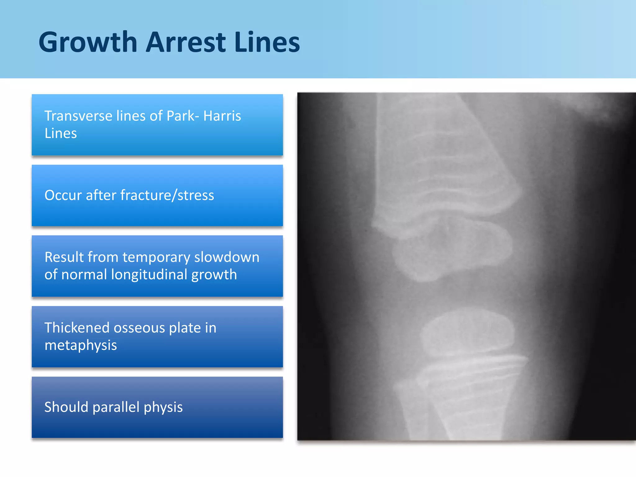 orthopaedic fractures in children | PPTX