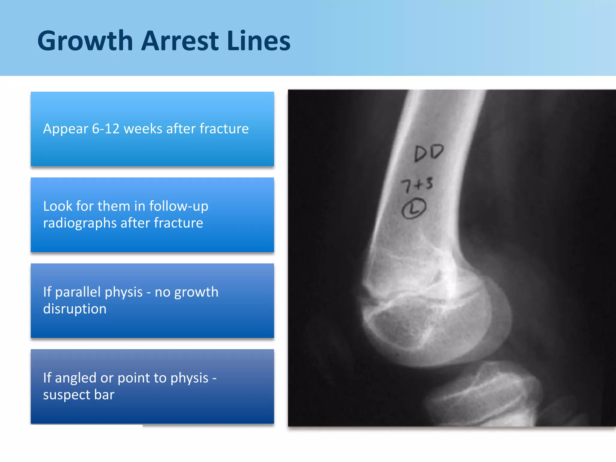 orthopaedic fractures in children | PPTX