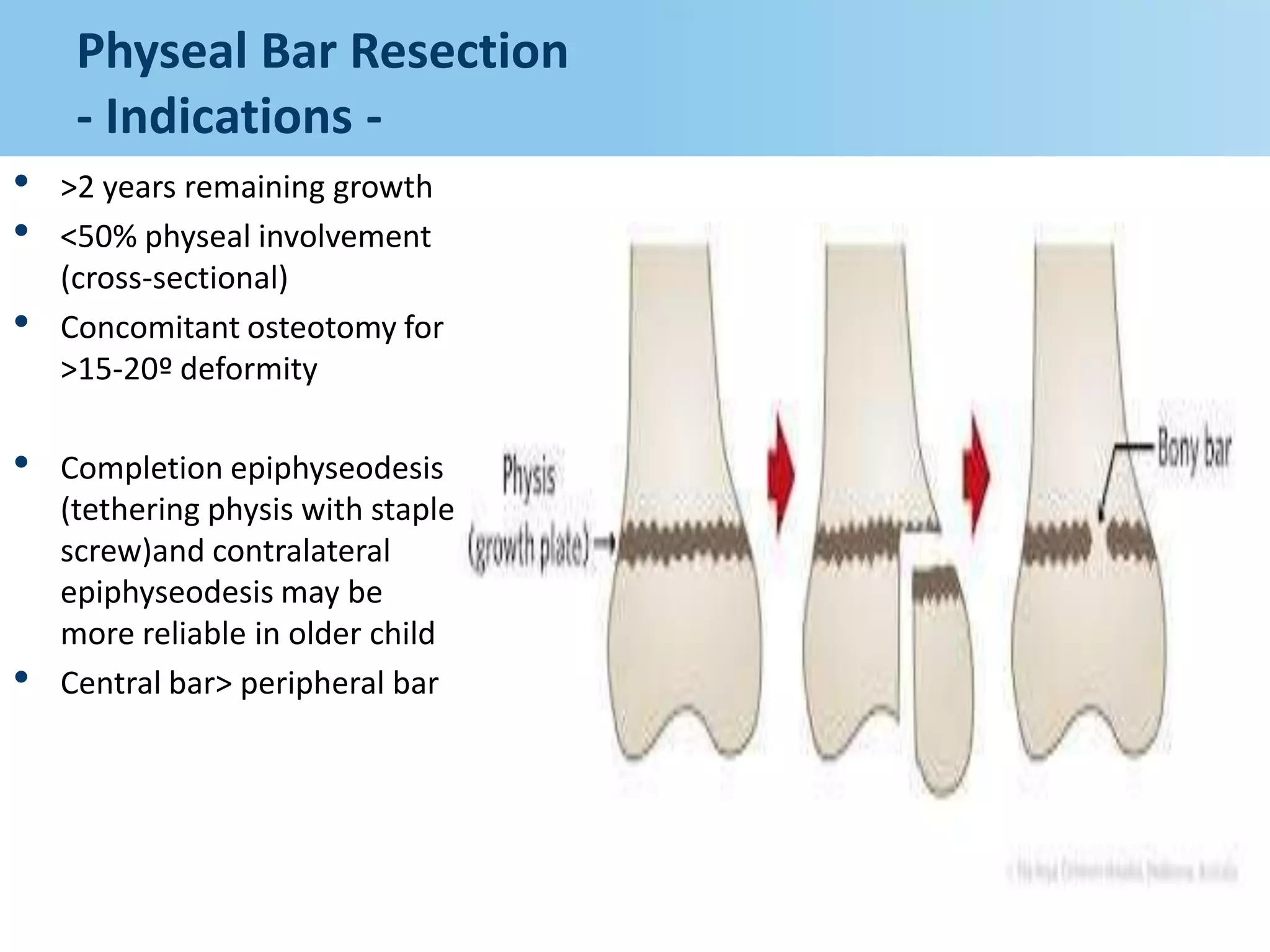 orthopaedic fractures in children | PPTX