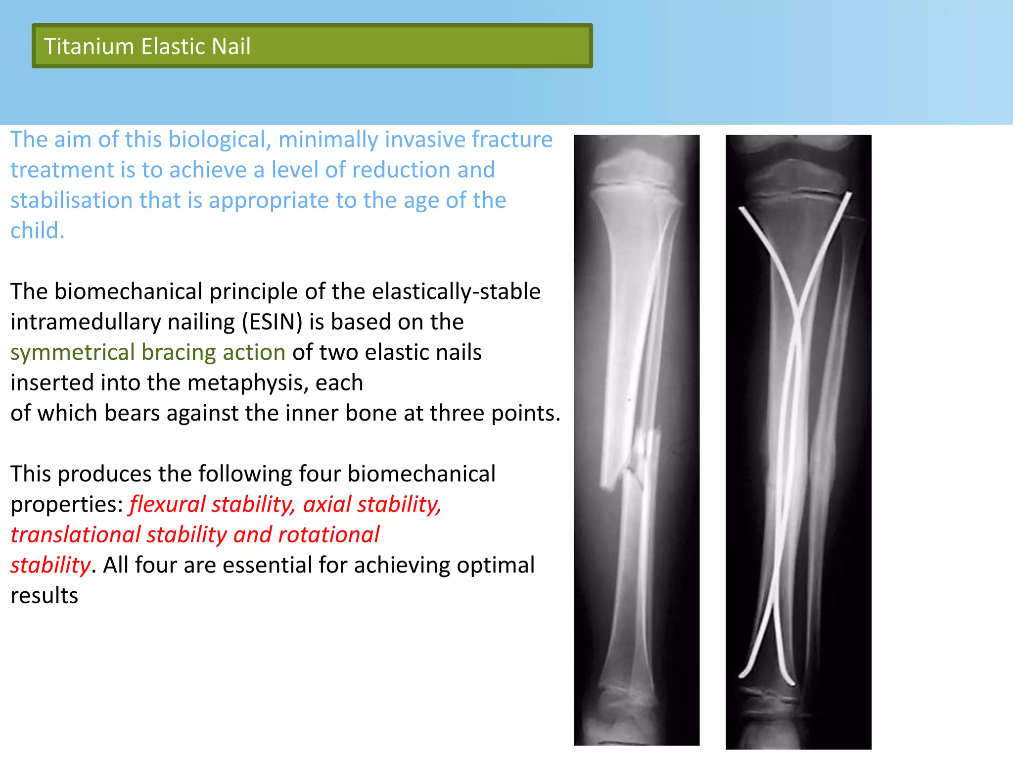 orthopaedic fractures in children | PPTX