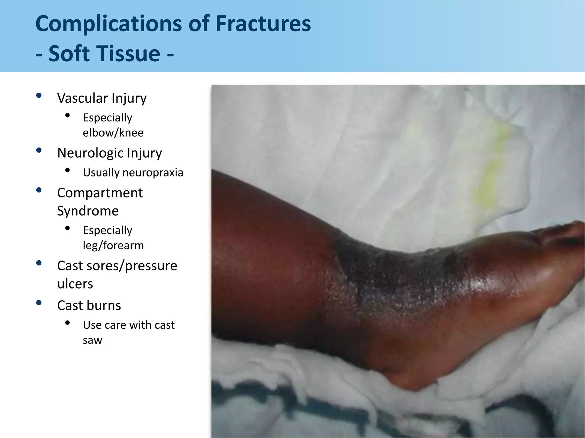 orthopaedic fractures in children | PPTX