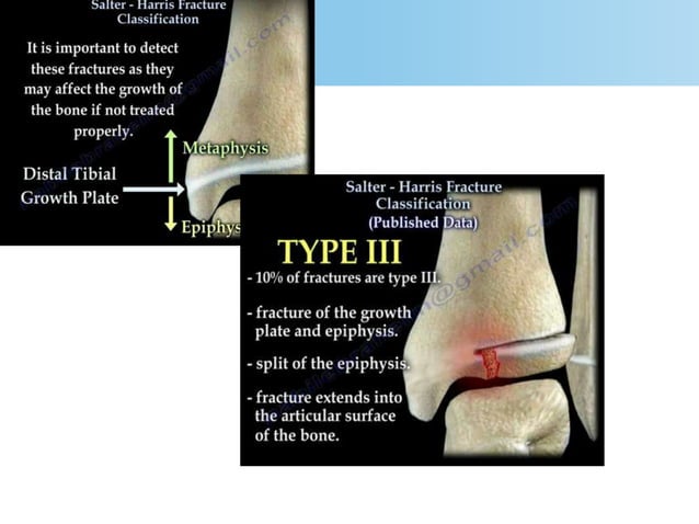 orthopaedic fractures in children | PPTX | Death, Injury, or Military ...