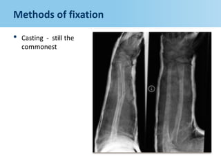 orthopaedic fractures in children | PPTX