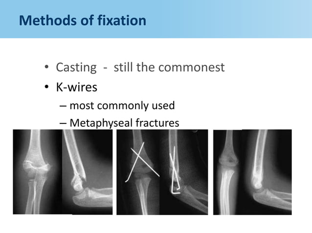 orthopaedic fractures in children | PPT