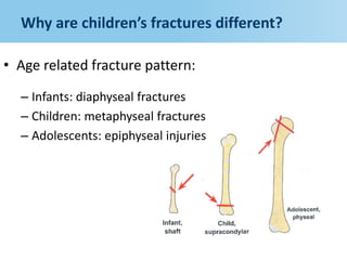 orthopaedic fractures in children | PPTX