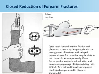 orthopaedic fractures in children | PPTX