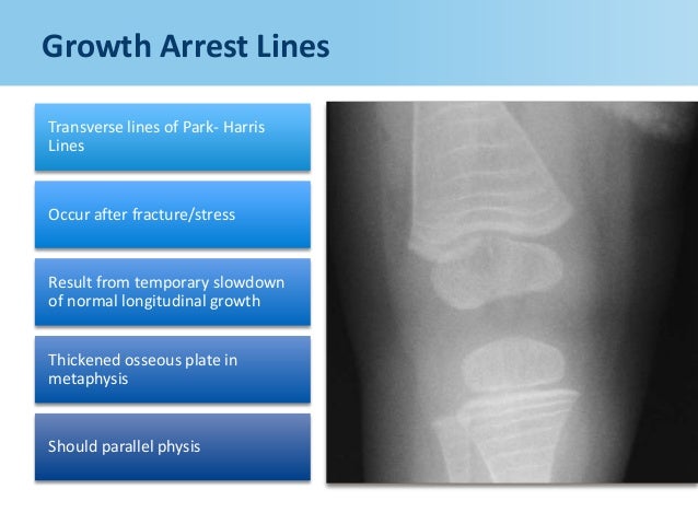 orthopaedic fractures in children