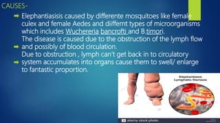 A seminar on Elephantiasis.pptx