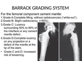 ASEPTIC LOOSENING OF TOTAL HIP REPLACEMNT AND MANAGEMENT .pptx