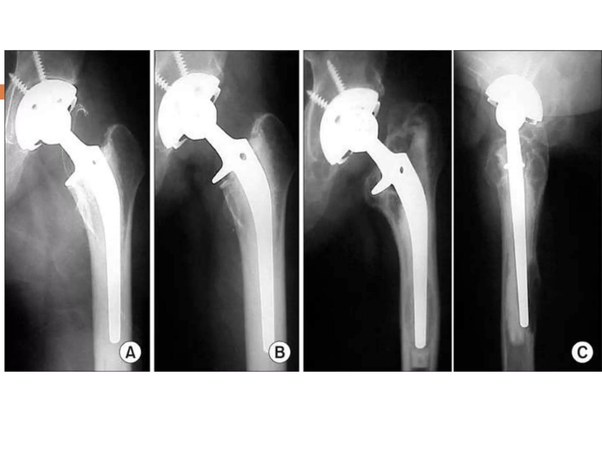 Aseptic loosening total hip arthroplasty | PPTX