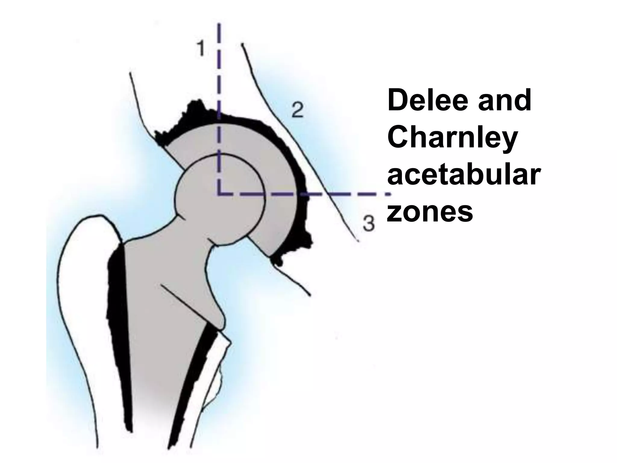 Aseptic loosening total hip arthroplasty | PPTX