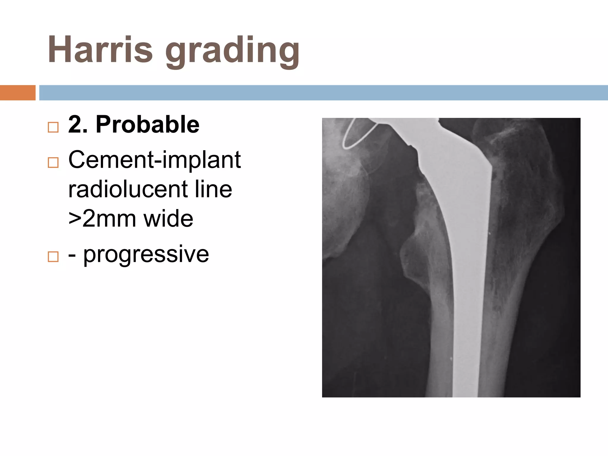 Aseptic loosening total hip arthroplasty | PPTX