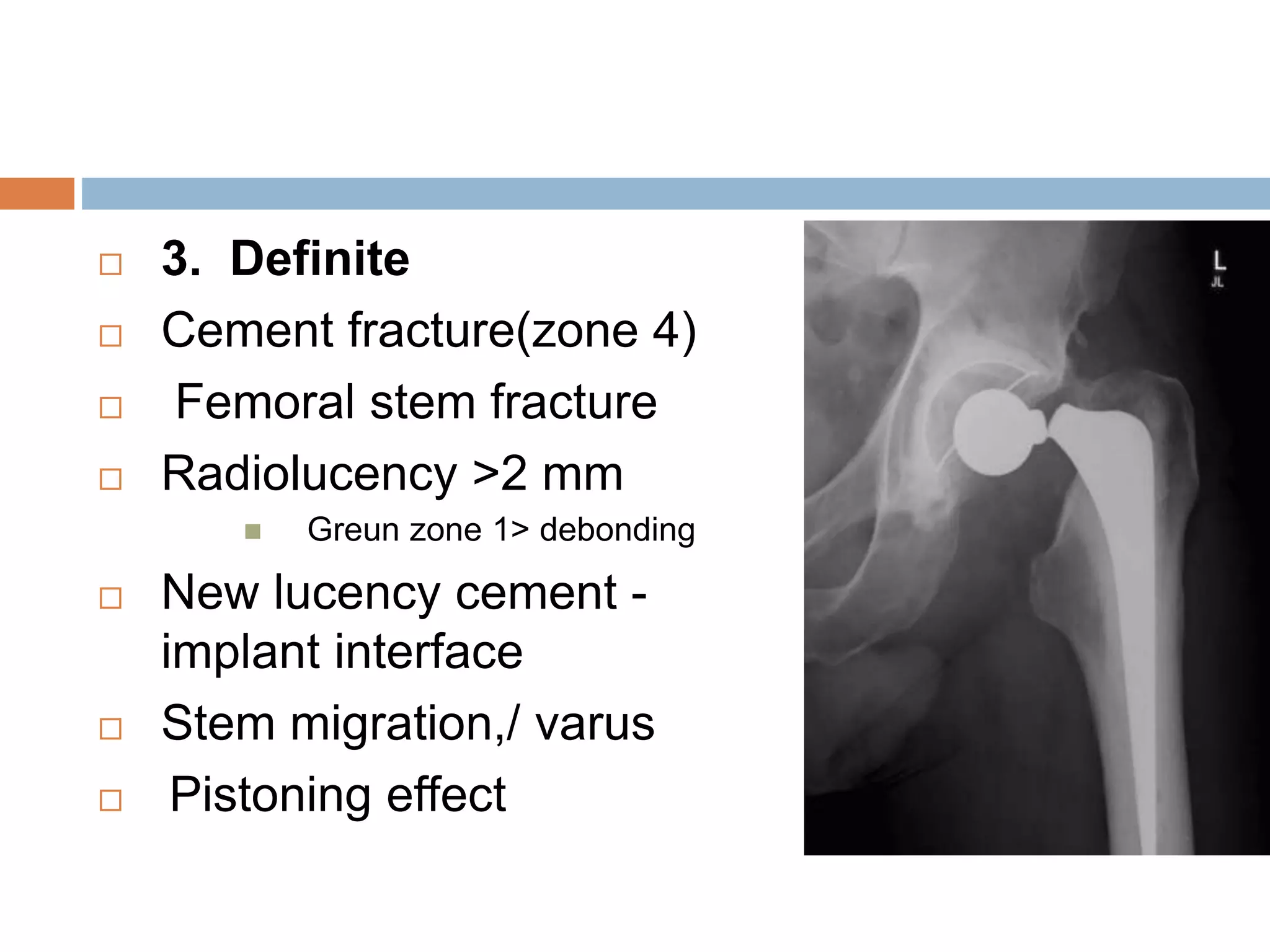 Aseptic loosening total hip arthroplasty | PPTX