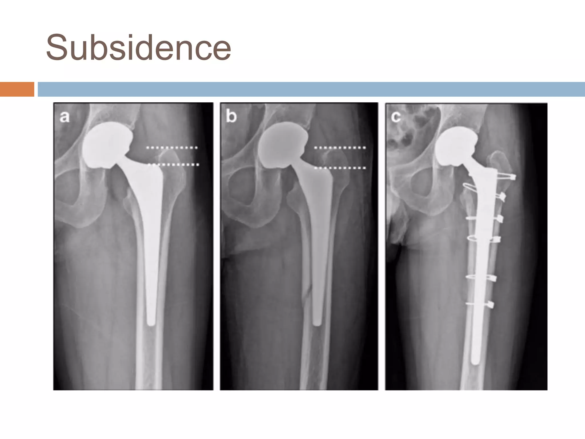 Aseptic loosening total hip arthroplasty | PPTX