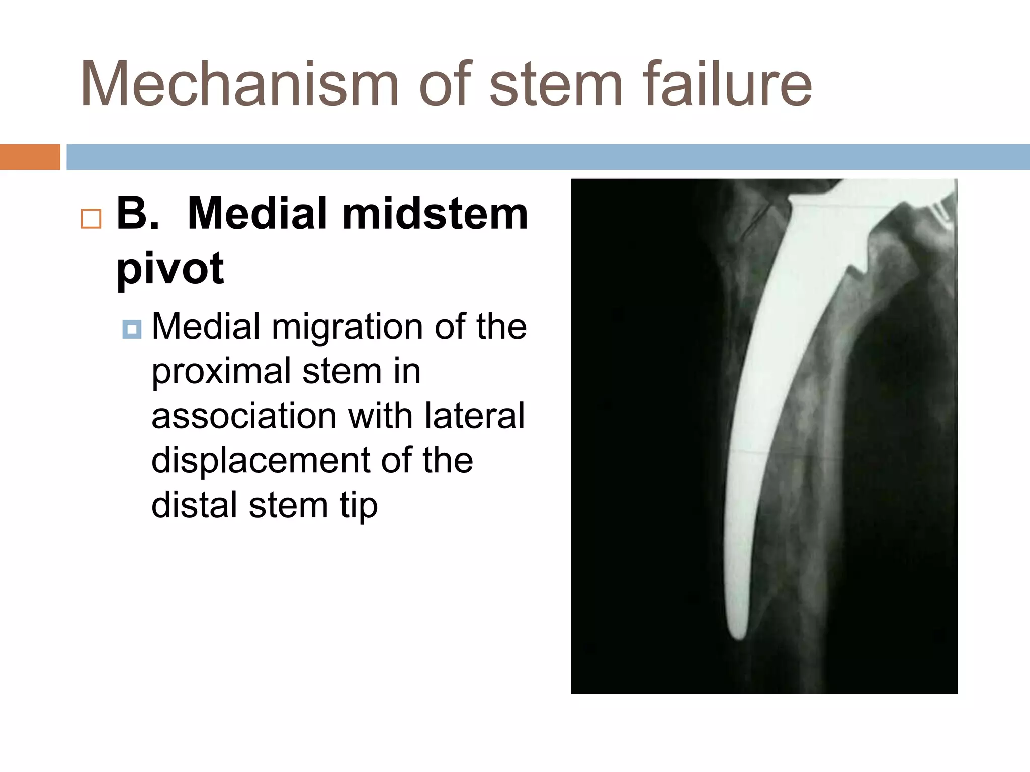 Aseptic loosening total hip arthroplasty | PPTX