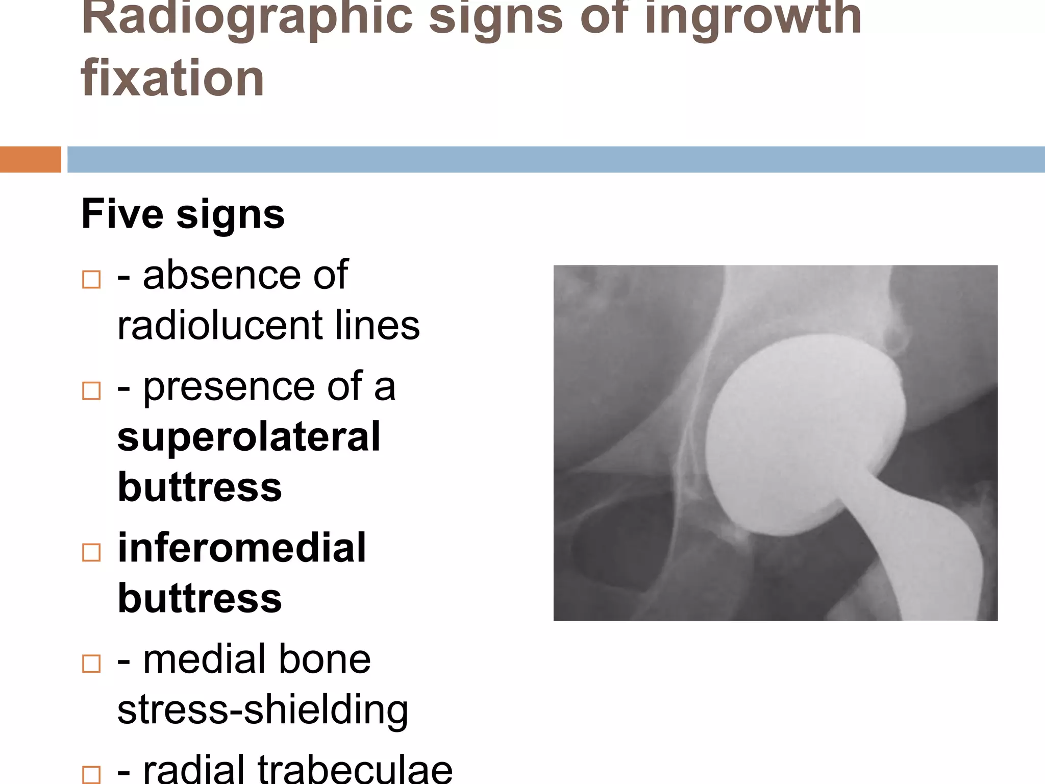 Aseptic loosening total hip arthroplasty | PPTX