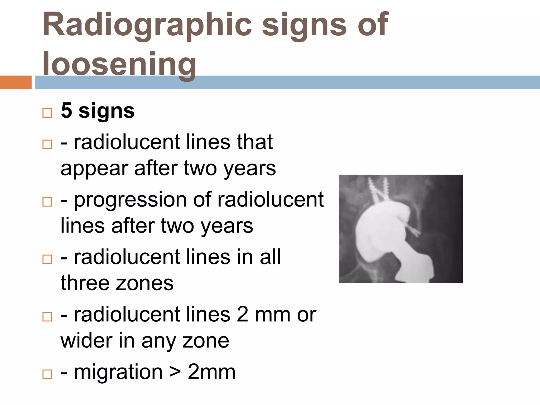 Aseptic loosening total hip arthroplasty | PPTX