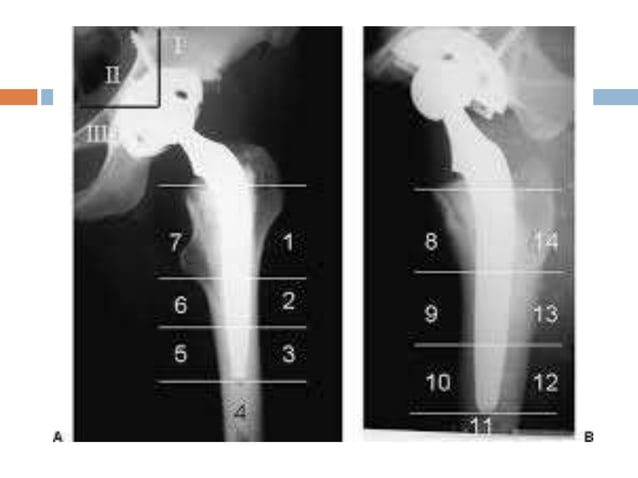Aseptic loosening total hip arthroplasty | PPTX | Bone and Joint ...