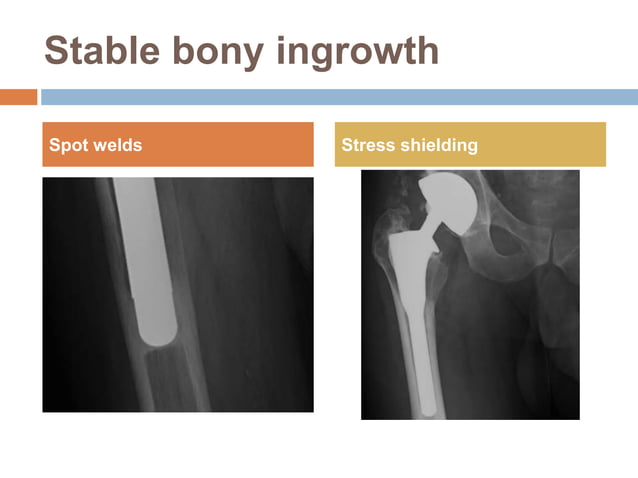 Aseptic loosening total hip arthroplasty | PPTX | Bone and Joint ...