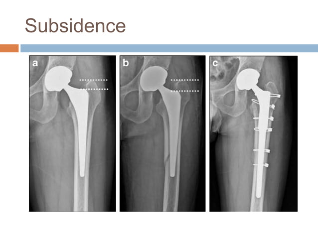 Aseptic loosening total hip arthroplasty