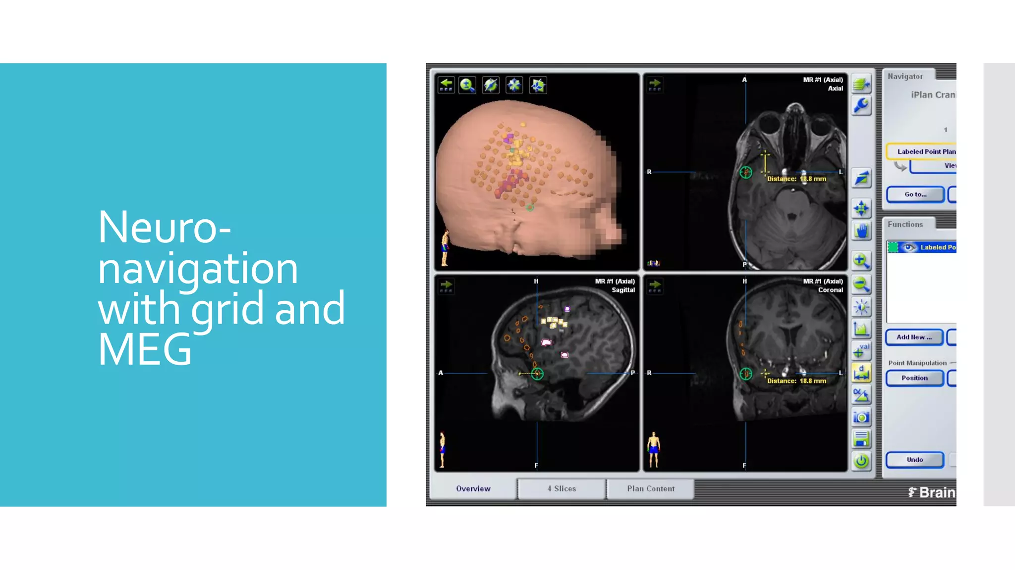 3d Localization Methods For Intracranial Electrodes Ppt