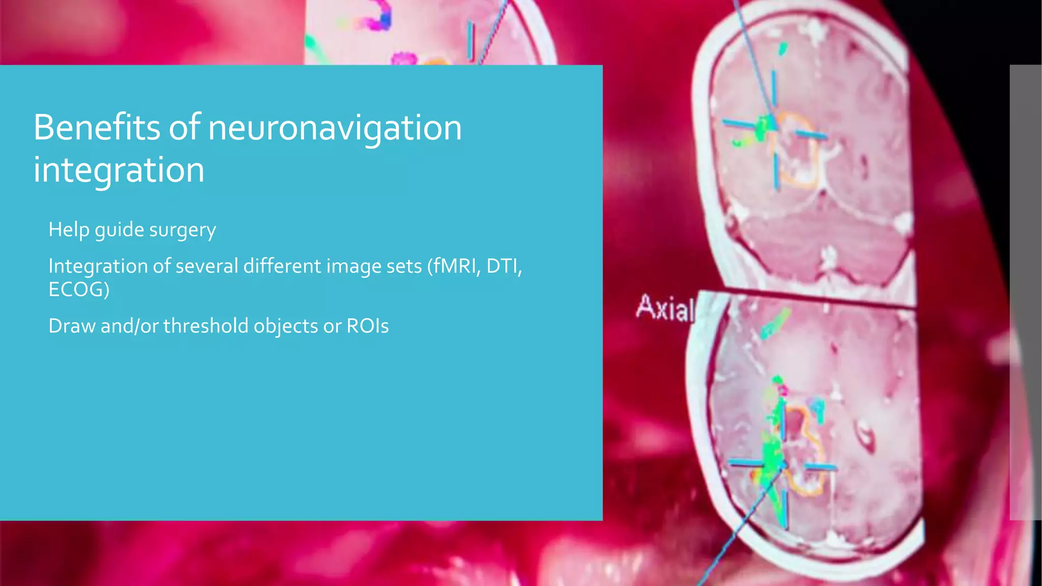3D localization methods for intracranial electrodes | PPT