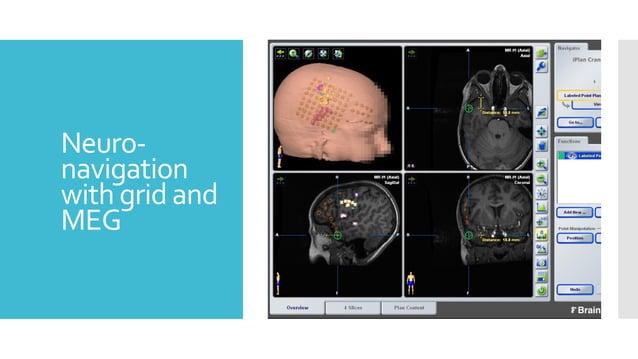 3D localization methods for intracranial electrodes | PPT