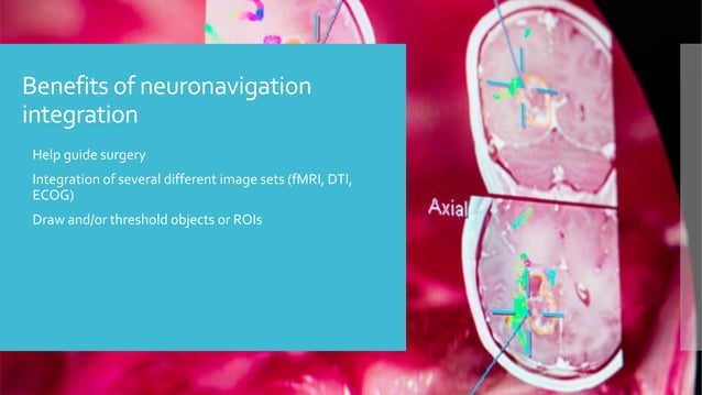 3D localization methods for intracranial electrodes | PPT