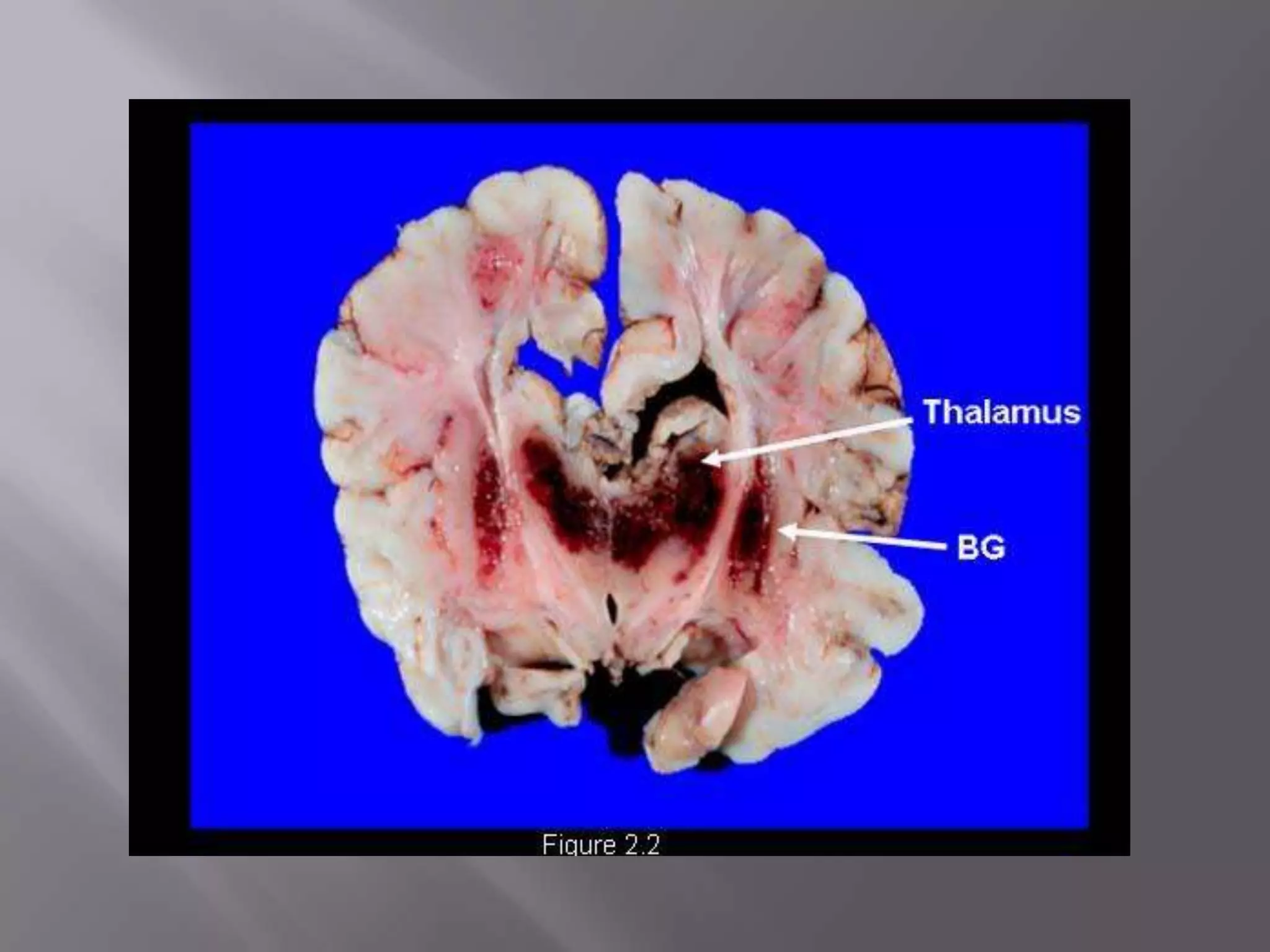 Asfiksija novorodjenceta milos markovic | PPT