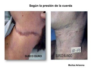 Manejo básico de afixias mecánicas y tratamiento | PPTX