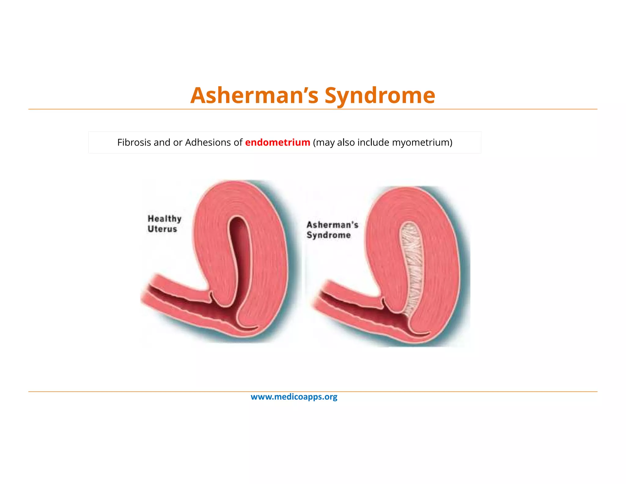 Asherman's syndrome | PDF