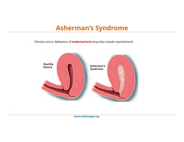 Asherman's syndrome