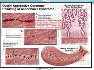ASHERMAN’S SYNDROME PPT SLIDES ASHERMANS | PPTX