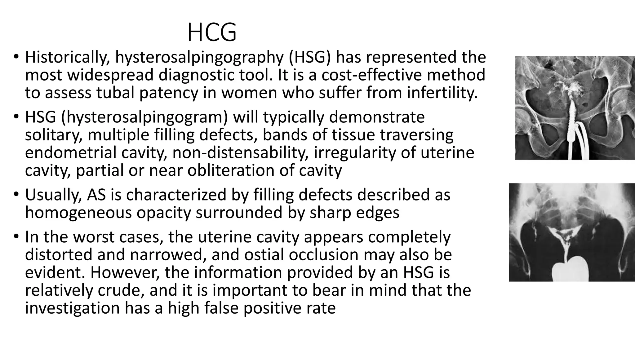 Asherman syndrome | PPTX