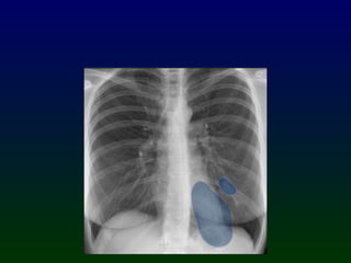 Cheat X-ray normal anatomy and patholgies For medical students | PPTX