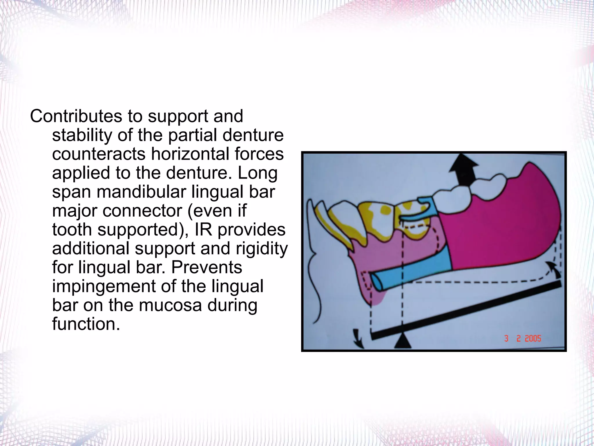 biomechanics in rpd | PPT