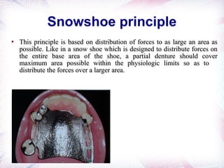 biomechanics in rpd | PPT
