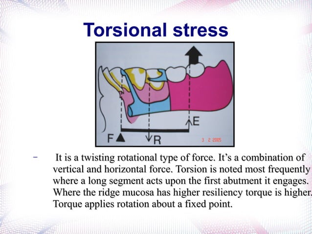 biomechanics in rpd | PPT | Dental Health | Diseases and Conditions