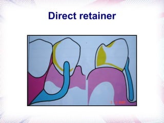 biomechanics in rpd | PPT