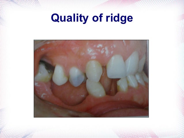 Classification of clamps, indications for use – MedMuv