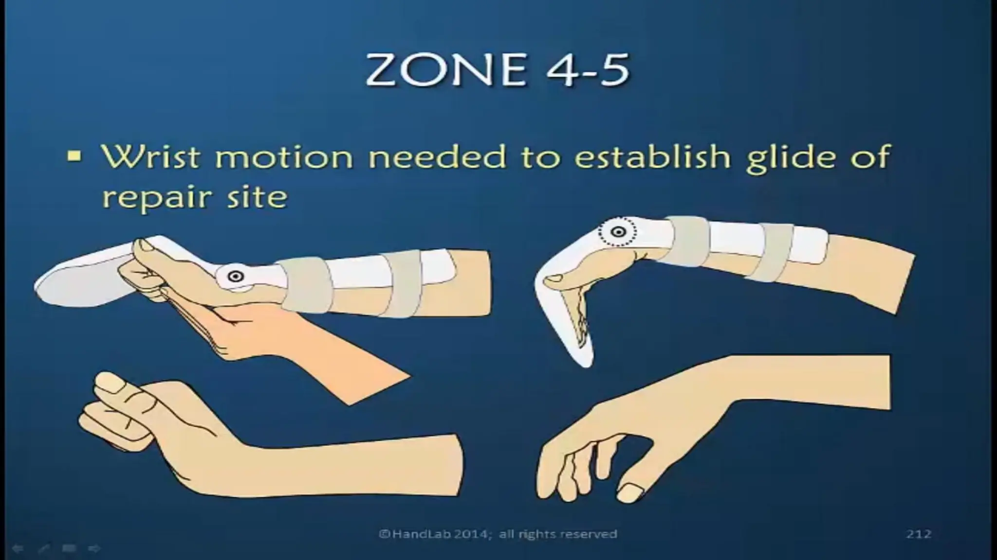 The zones of the hand flexor refer to anatomical areas of the hand ...