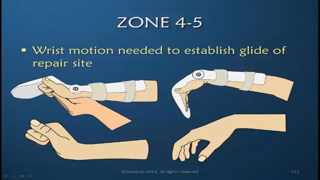 The zones of the hand flexor refer to anatomical areas of the hand ...