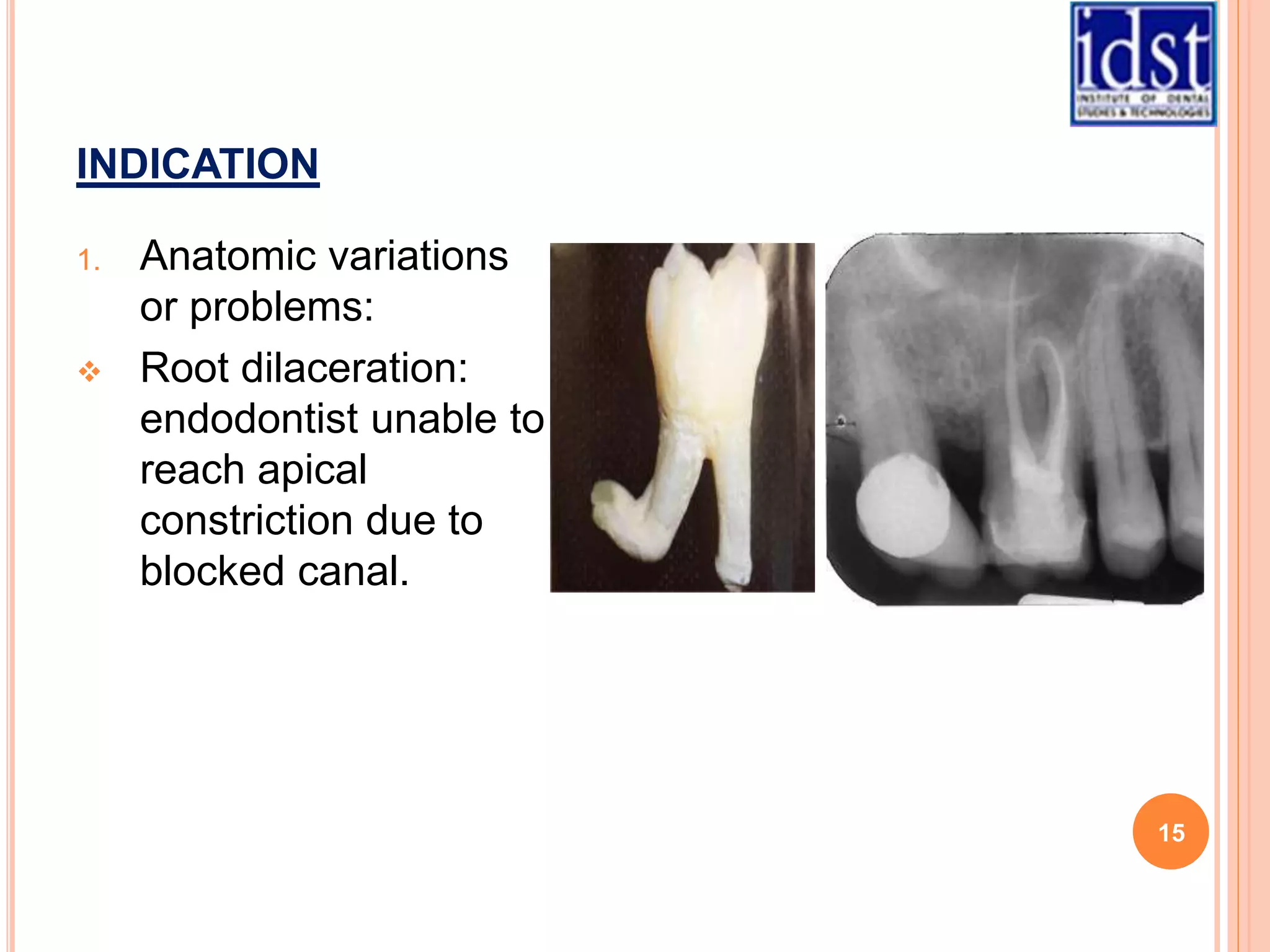 Endodontic surgery Part 1 | PPTX