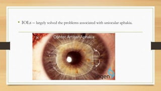 Aphakia - Ashith Tripathi | PPTX