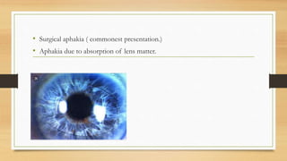 Aphakia - Ashith Tripathi | PPT