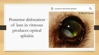 Aphakia - Ashith Tripathi | PPTX