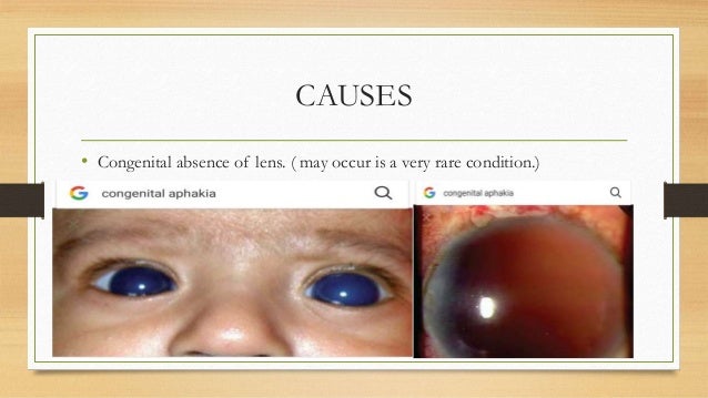 Aphakia - Ashith Tripathi