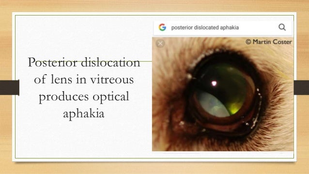 Aphakia - Ashith Tripathi