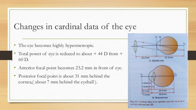 Aphakia - Ashith Tripathi