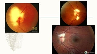 Retina - Congenital anomalies and RD by Ashith Tripathi | PPTX